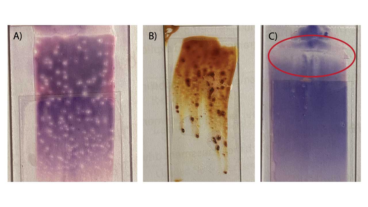 Preparation of Peripheral Blood Smear: The Do's and Don't's