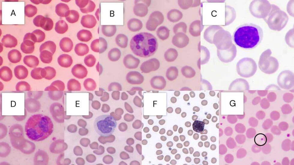 Leishman Stain for Peripheral Blood Smear Principle & Procedure