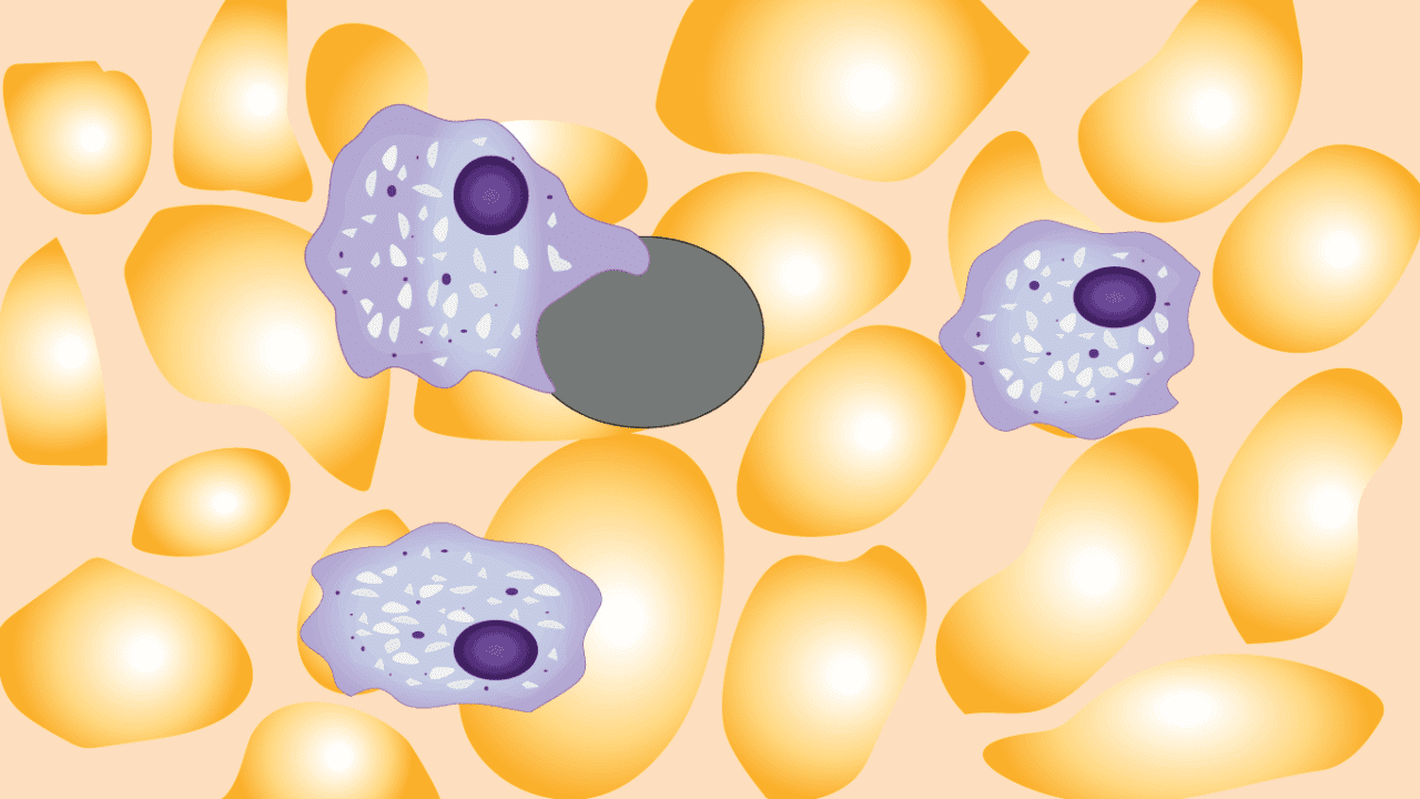 Immune thrombocytopenia (ITP): Symptoms & Diagnosis