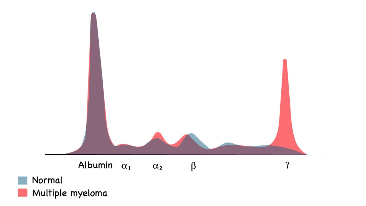 Smoldering Multiple Myeloma (SMM): Symptoms & Treatment
