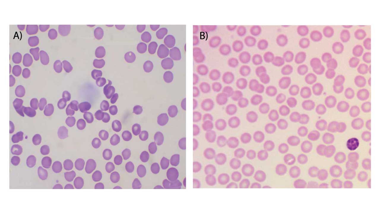 Preparation of Peripheral Blood Smear: The Do's and Don't's