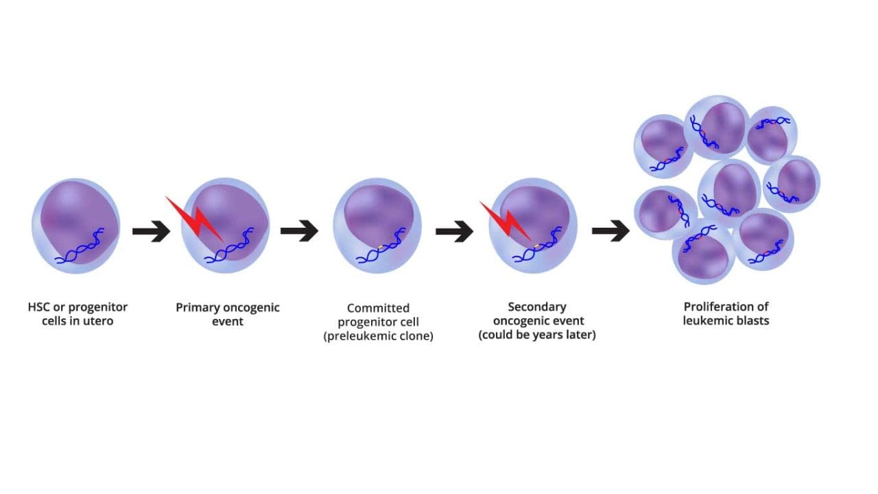 T-cell Acute Lymphoblastic Leukemia: Symptoms & Diagnosis
