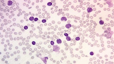 B-cell Acute Lymphoblastic Leukemia (B-ALL): Symptoms & Diagnosis