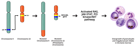 Chronic Myeloid Leukemia or CML: Symptoms, Diagnosis & Treatment