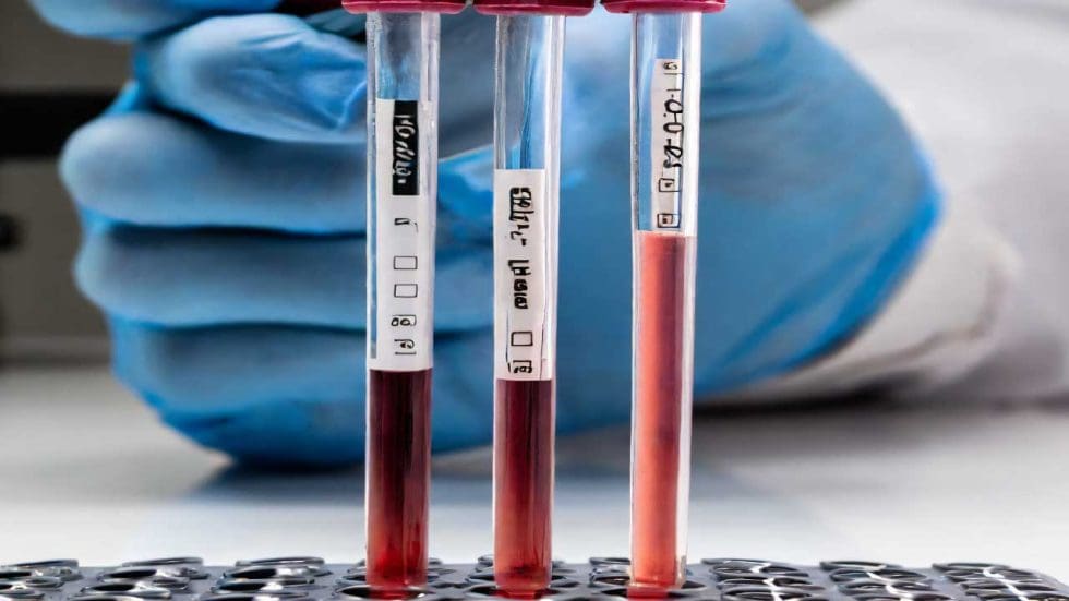Erythrocyte Sedimentation Rate (ESR): Principle & Protocol