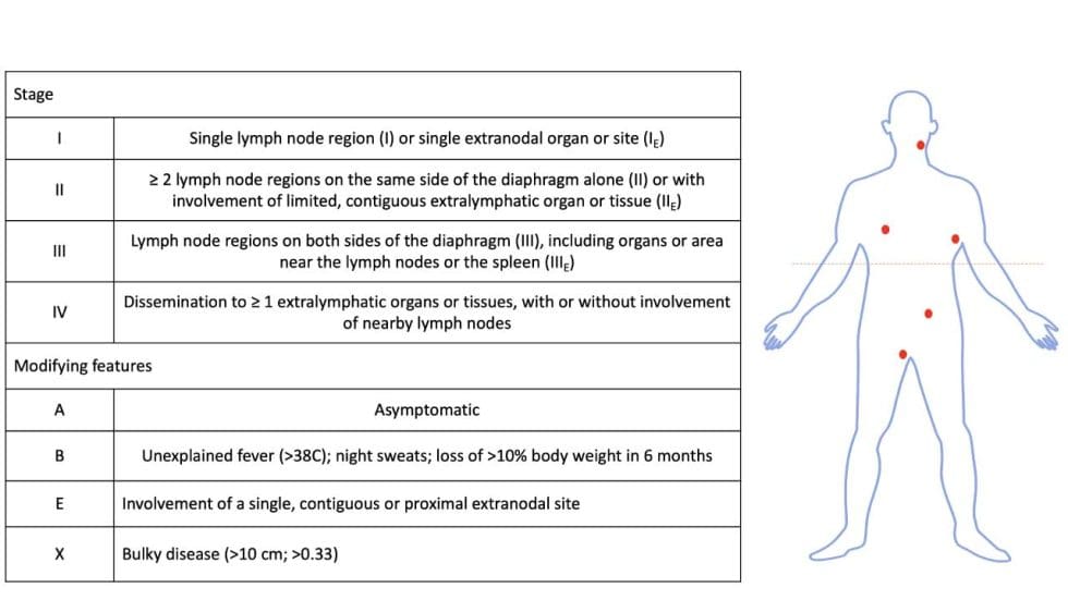 Diffuse Large B-Cell Lymphoma or DLBCL: Symptoms & Treatment