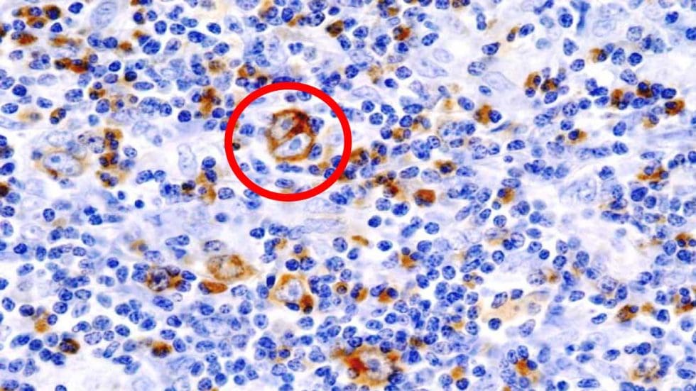 Lymphoma Overview: Symptoms, Diagnosis & Treatment
