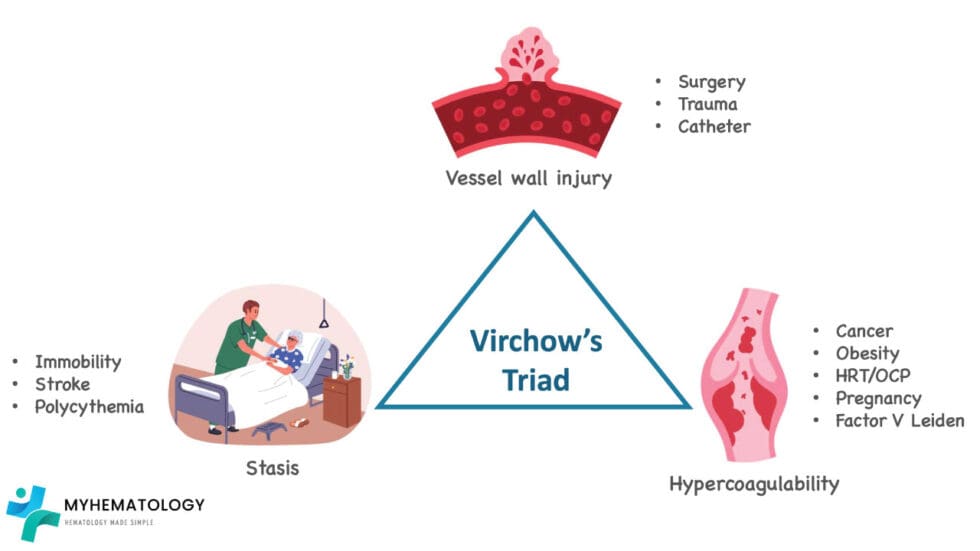 Venous Thrombosis - VTE: Symptoms, Causes & Investigations