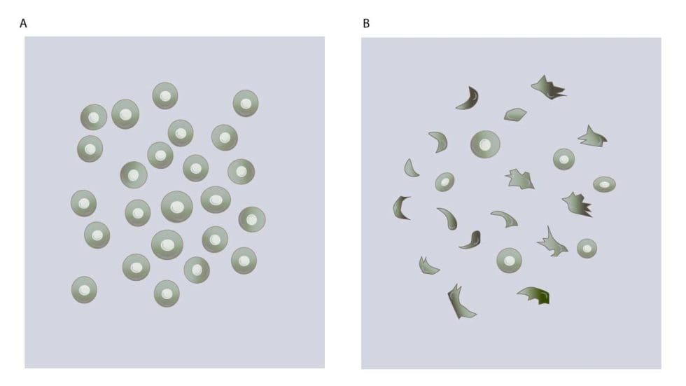 Sickle Cell Disease Test: A Guide to Dithionite Solubility Method