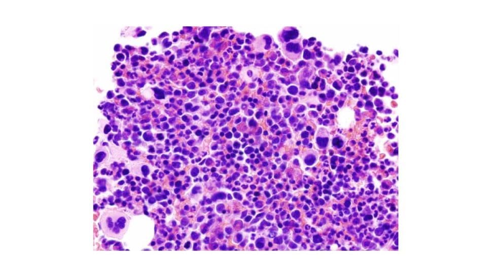 Essential Thrombocythemia (ET): Causes, Symptoms & Diagnosis