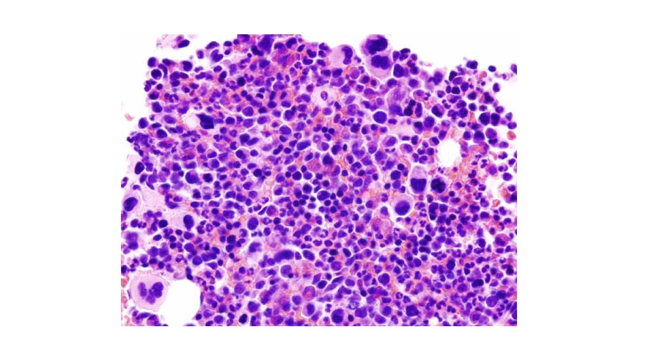 Essential Thrombocythemia (ET): Causes, Symptoms & Diagnosis