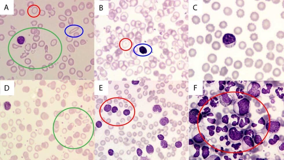 Leishman Stain for Peripheral Blood Smear Principle & Procedure