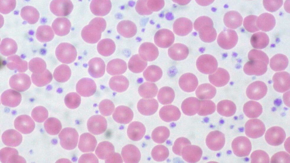 Myeloproliferative Neoplasms (MPNs): Symptoms, Types & Diagnosis