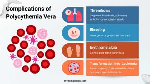Polycythemia Vera: Causes, Pathophysiology, Symptoms & Treatment