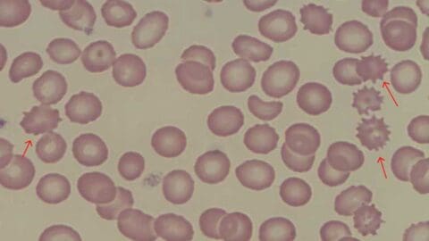 Abnormal Red Blood Cell Morphology: Causes & Interpretation