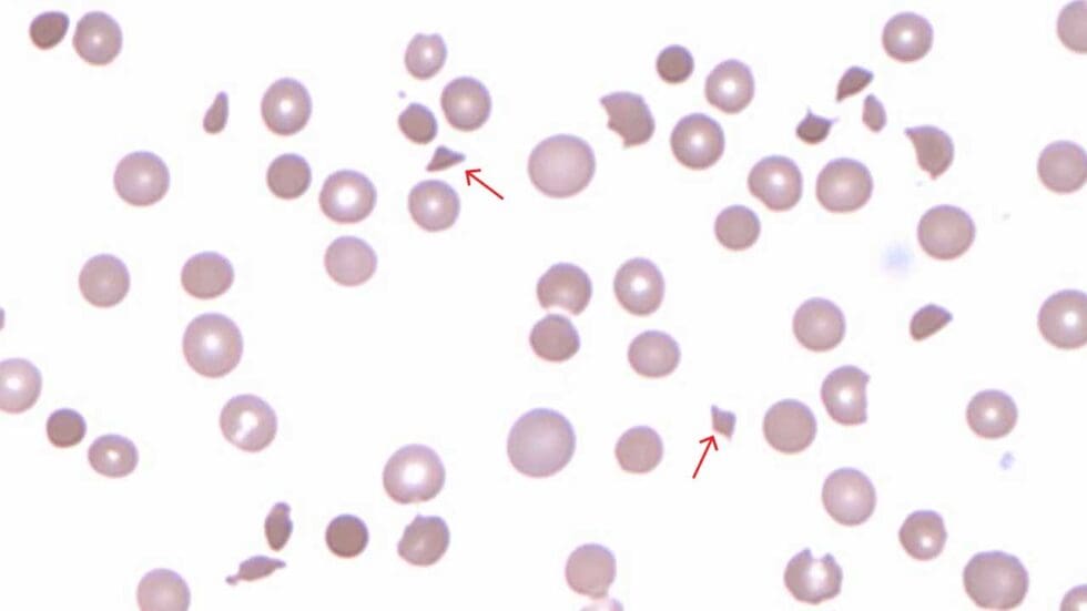 Abnormal Red Blood Cell Morphology: Causes & Interpretation
