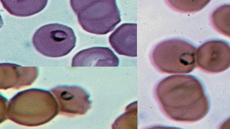 Red Blood Cell (RBC) Inclusion Bodies: Types and Causes