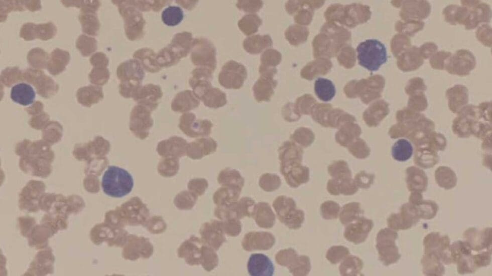 Red Blood Cell (RBC) Abnormal Morphology: Description and Causes