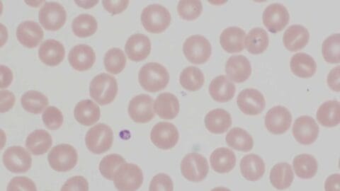 Abnormal Red Blood Cell Morphology: Causes & Interpretation