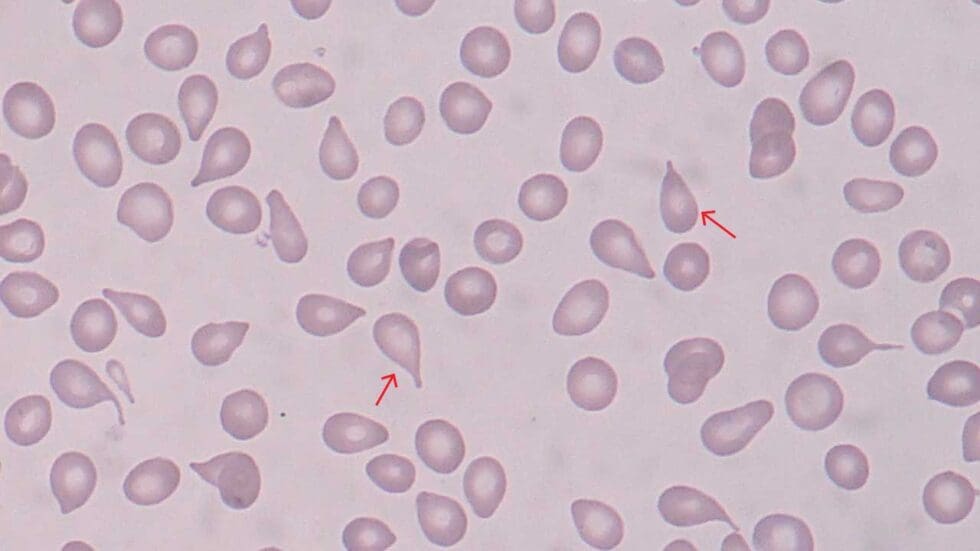 Abnormal Red Blood Cell Morphology: Causes & Interpretation