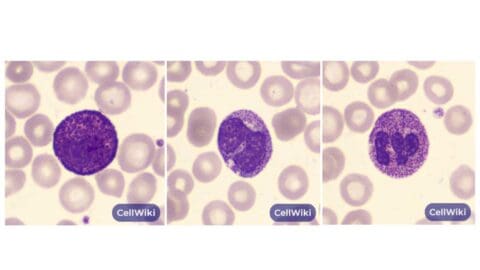 Abnormal WBC Morphology: Description, Types and Causes