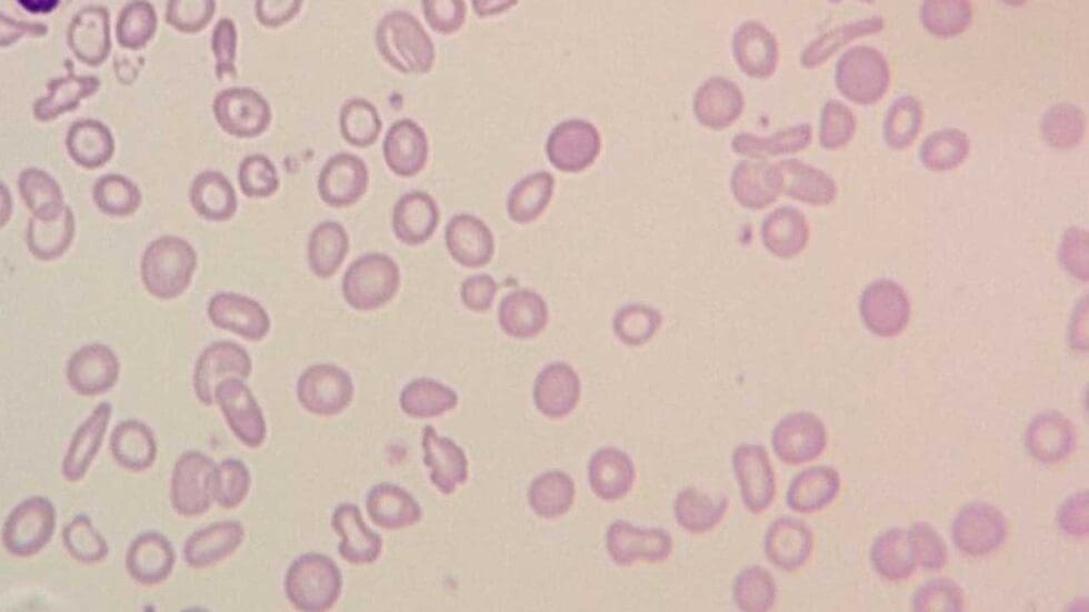 Microcytic Anemia: Causes of Hypochromia and Microcytosis