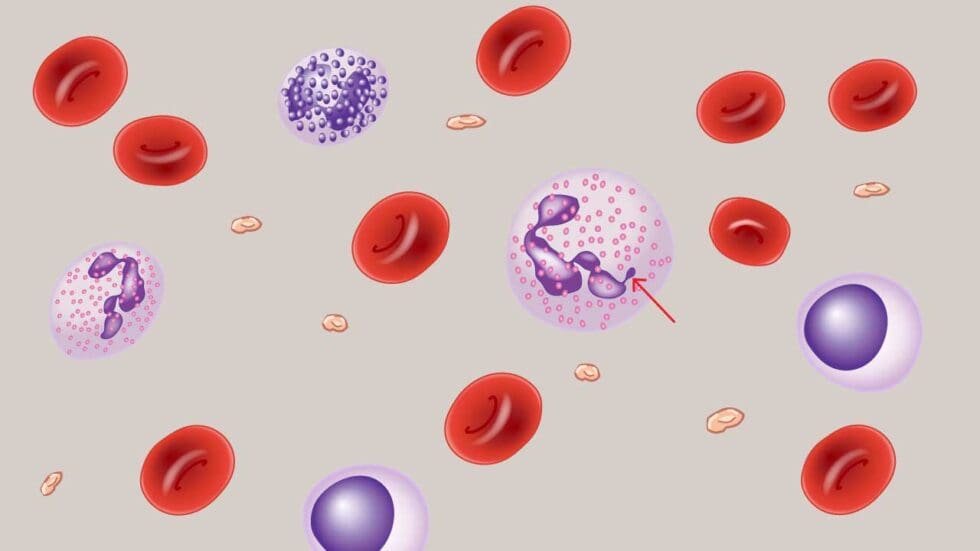 Abnormal WBC Morphology: Description, Types and Causes
