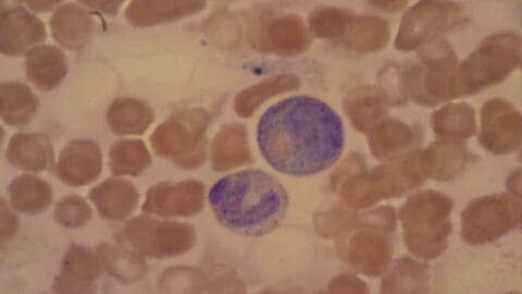 Abnormal WBC Morphology: Description, Types and Causes