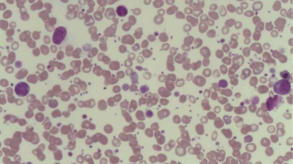 Immune thrombocytopenia (ITP): Symptoms & Diagnosis