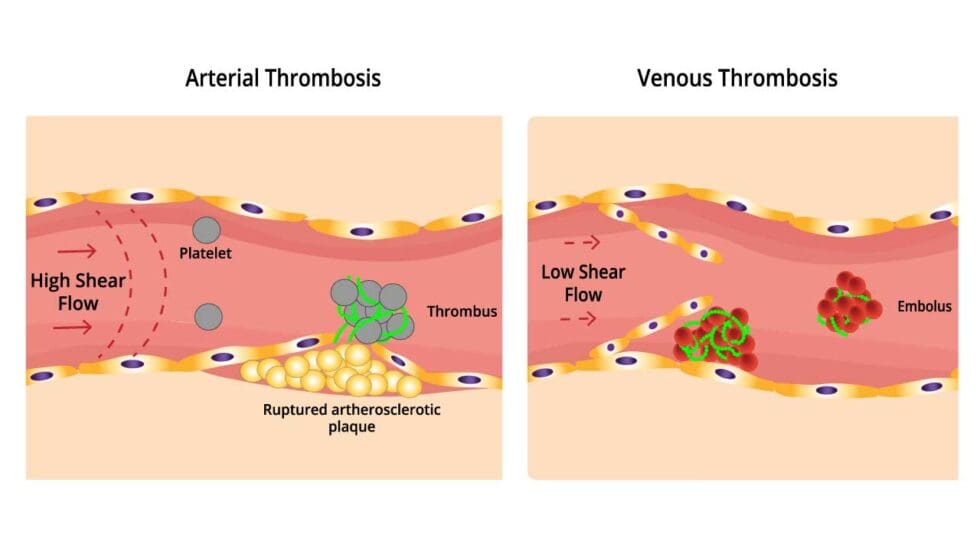 Thrombosis: Causes, Symptoms, Diagnosis & Treatment