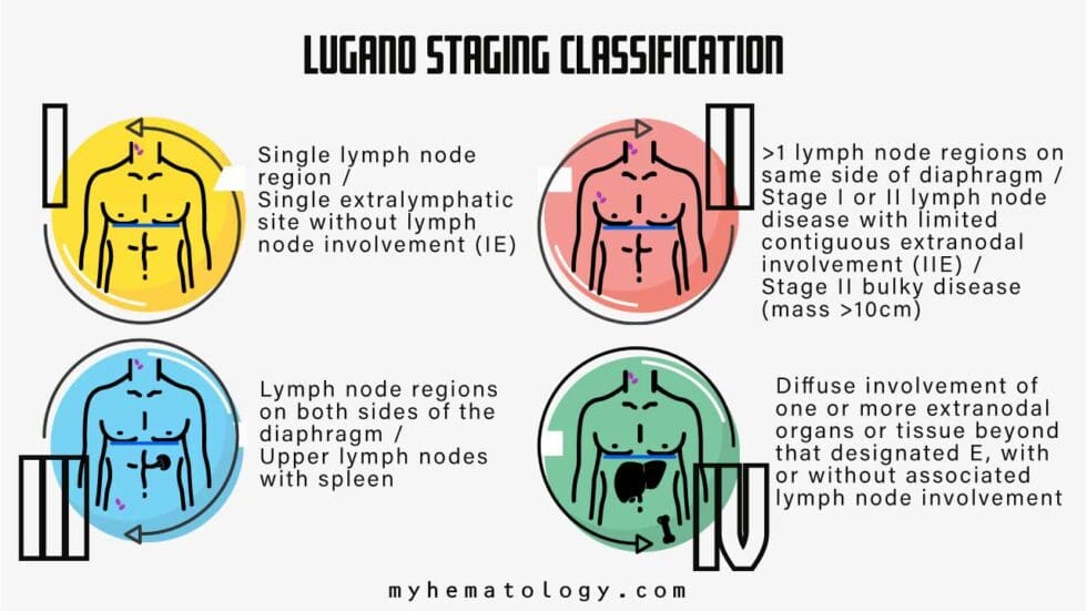 Non-Hodgkin Lymphoma: Symptoms, Diagnosis, Treatment & Subtypes