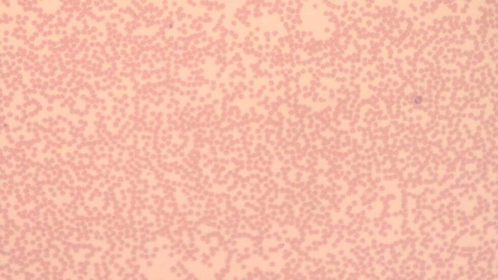 Leukopenia (Low White Cell Count): Causes, Symptoms & Treatment