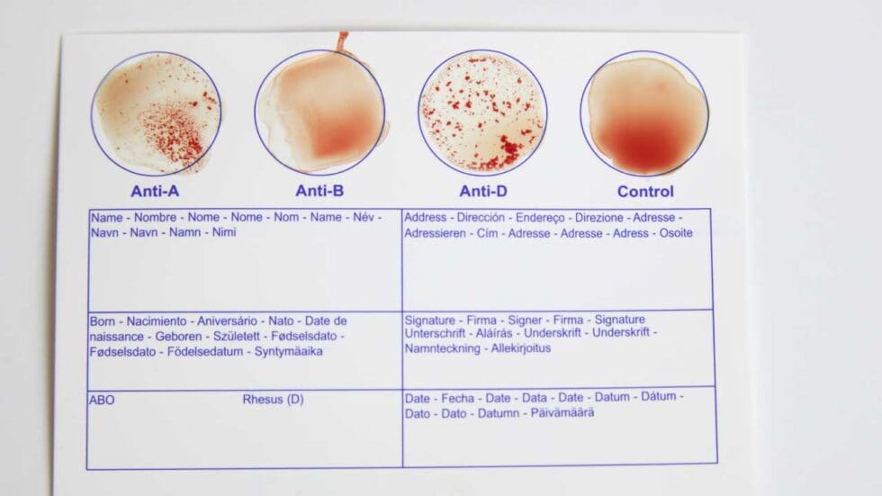 ABO Blood Group System: Antigens, Typing and Tests