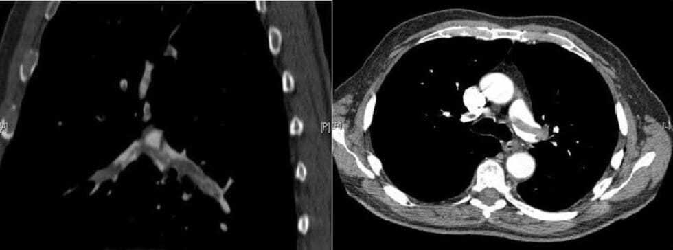 Pulmonary Embolism (PE): Causes, Symptoms & Treatment