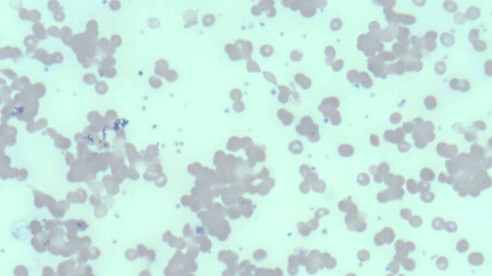 Cold Agglutinin Disease: Causes, Symptoms & Treatment