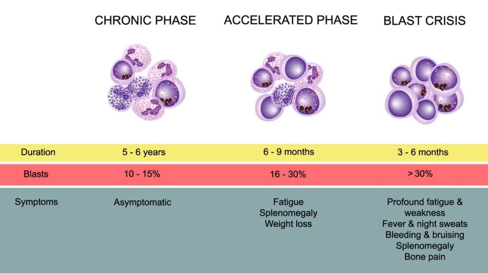 Chronic Myeloid Leukemia Treatment Strategies: An Overview