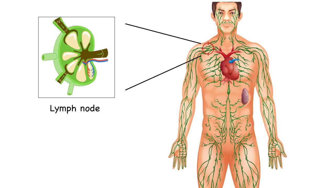 Lymphadenopathy: Causes, Symptoms, Investigation & Treatment