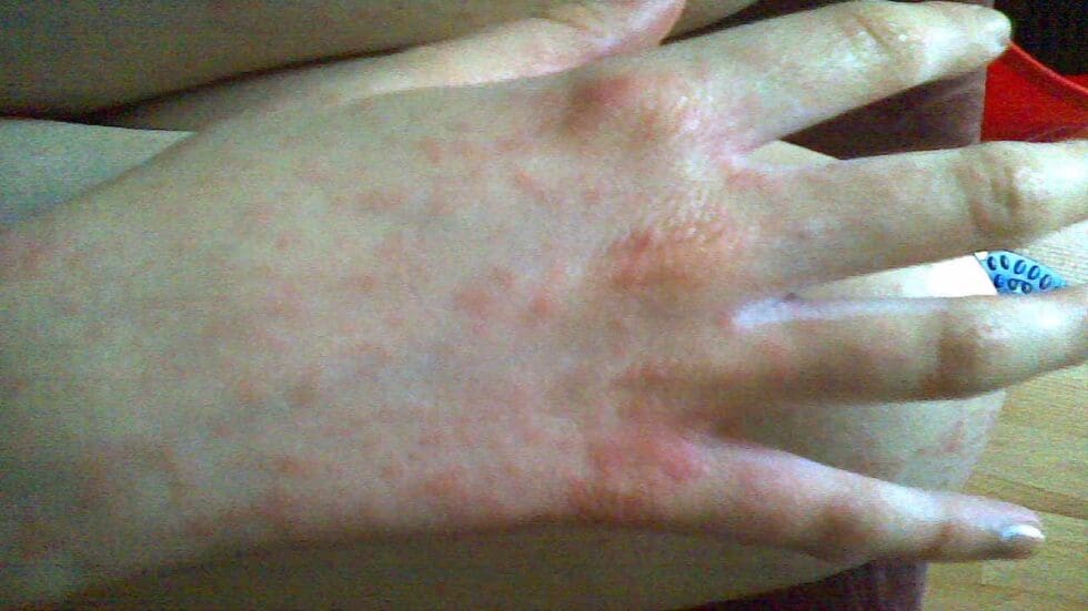 Infectious Mononucleosis (Mono): Causes, Symptoms & Treatment