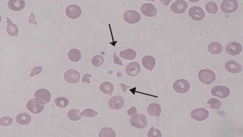 Hemolytic Uremic Syndrome (HUS): Causes, Symptoms & Treatment