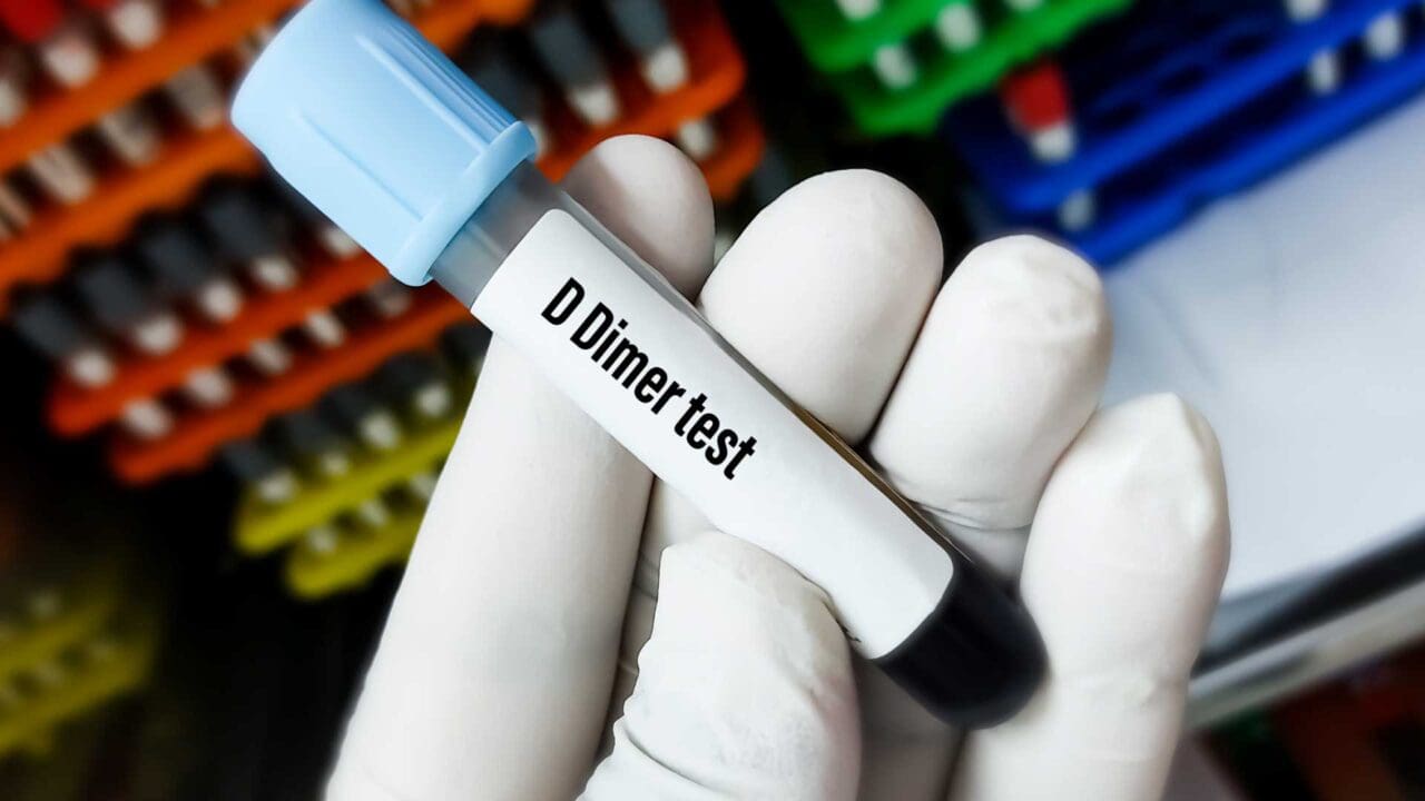 D-Dimer Test: What is it? Principle, Protocol & Interpretation