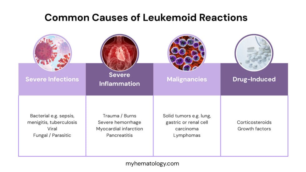 Leukemoid Reaction: Causes, Symptoms & Laboratory Investigations