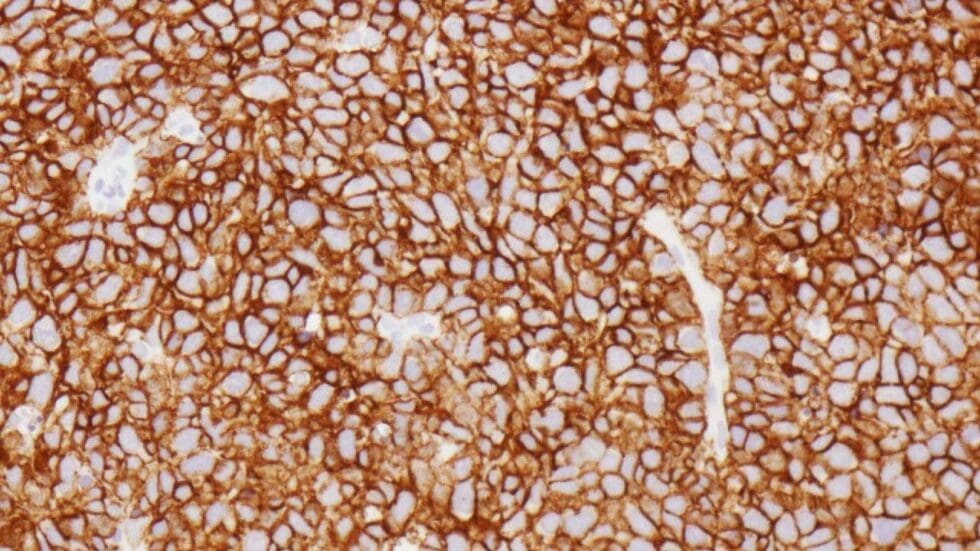 Diffuse Large B-Cell Lymphoma or DLBCL: Symptoms & Treatment