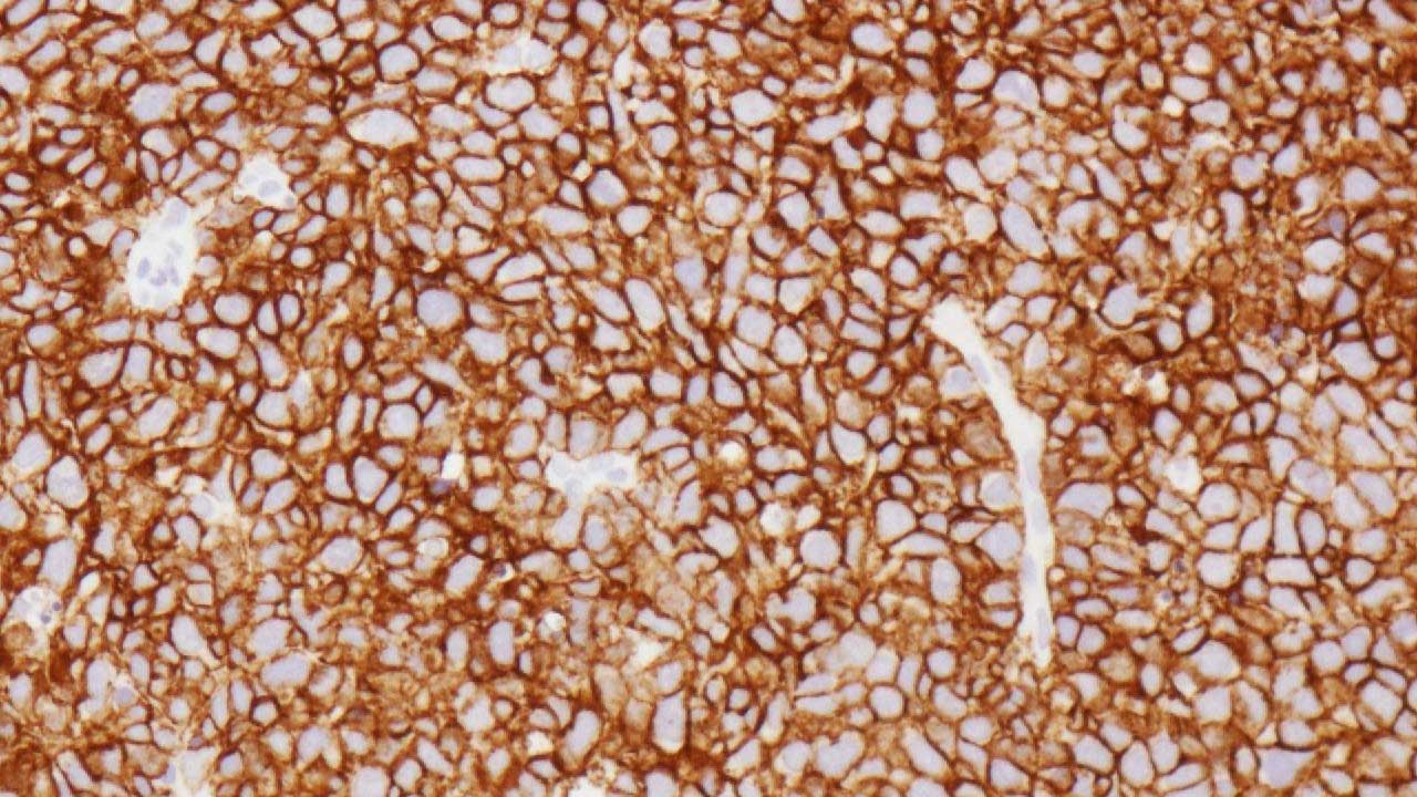 Diffuse Large B-Cell Lymphoma or DLBCL: Symptoms & Treatment