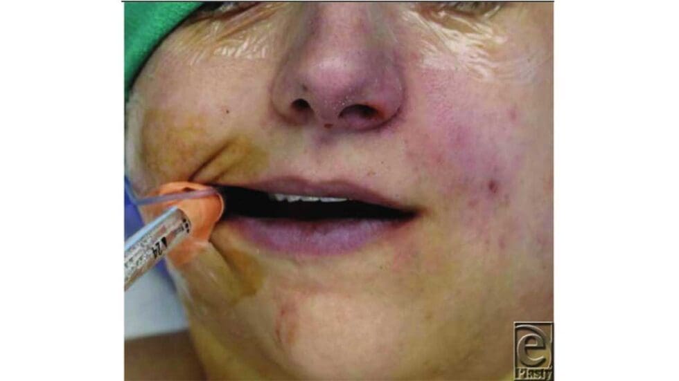 Methemoglobinemia: Causes, Symptoms, Diagnosis & Treatment